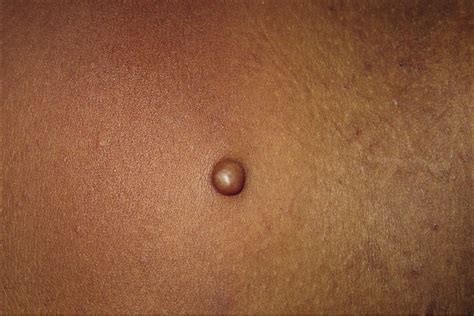 Atypical Clinical And Dermoscopic Features Of Hobnail Hemangioma