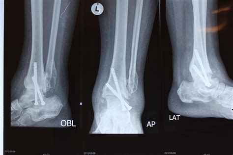 Ankle Arthrodesis Foot And Ankle Orthobullets