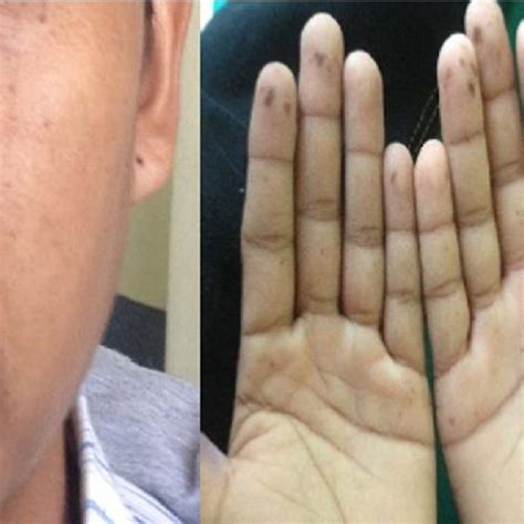 Images Showing Hyperpigmented Macules On The Lips Palms And Sole