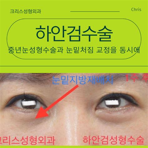 하안검수술가격과 눈 밑 지방재배치 수술 비용 차이를 비교 강남 압구정 눈 성형 전문의 네이버 블로그