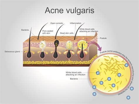 What Is Acne Vulgaris