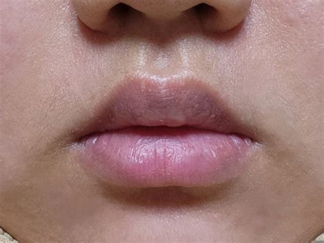 입술 필러 지식in