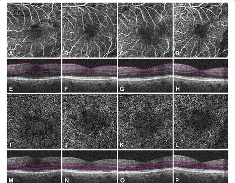 OCTA A D I L And Corresponding Structural OCT E H M P Images Of A Download Scientific