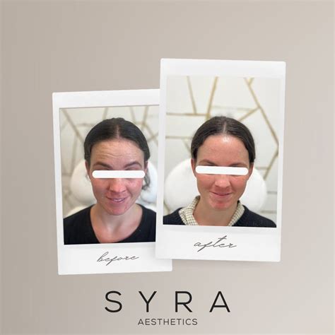 Jeuveau Vs Botox How To Choose The Right Treatment