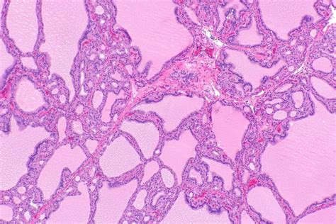 Can You Die From Graves Disease Life Expectancy Explained