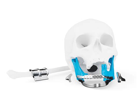 Jaw Reconstruction Tecumed Sro Jaw Reconstruction Tecumed Sro