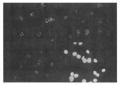 Polysomy 7 Upper Left Trisomy 11 Upper Right Monosomy 12 Lower