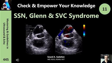 Ssn Window Glenn Procedure And Svc Syndrome Youtube