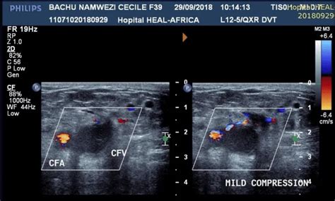 Duplex Ultrasound In Upper And Lower Limb Deep Venous Thrombosis