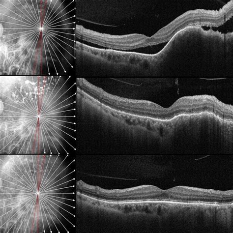 Serial Optical Coherence Tomography Oct Of Our Patient With Choroidal Download Scientific