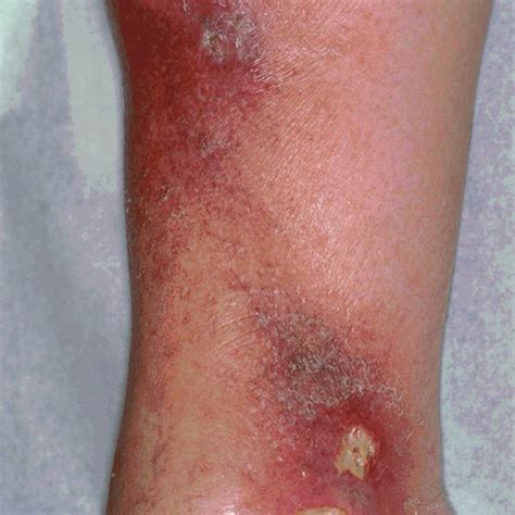 Initial Ulcers Diagnosed As Pyoderma Gangrenosum Fig 2 Initial