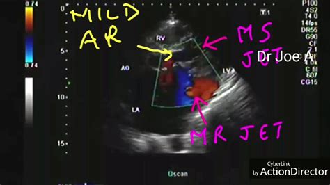 Echo Mitral Stenosis Mr Mild Ar Youtube