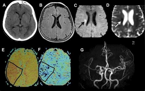 Diffusion Mr Imaging In Central Nervous System Radiology Key