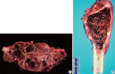 Aneurysmal Bone Cyst Tibia