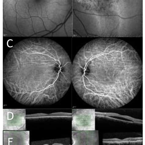 Multimodal Imaging Of Case 1 A Optos Imaging Showing Chorioretinal Download Scientific Diagram