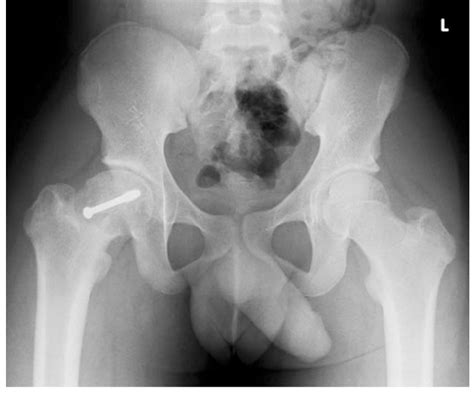 Ap Pelvis Radiograph Showing Post Scfe Secondary Cam Deformity Of The Download Scientific