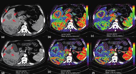 A C Axial Imaging Of Contrast Enhanced And Perfusion Ct Scan Of Download Scientific Diagram