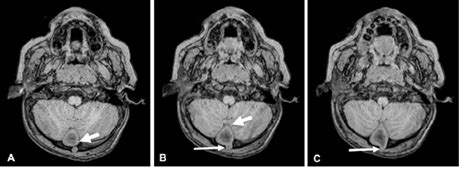 Figure 3 From Occipital Intraosseous Dermoid Cyst With Restricted