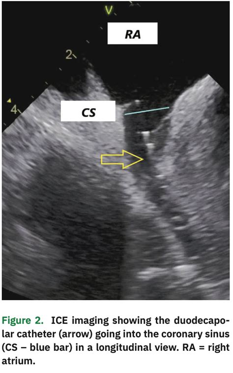 Catheter Ablation For Atrial Fibrillation Without X Rays The Zero