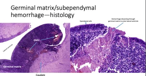 Germinal Matrix Histology