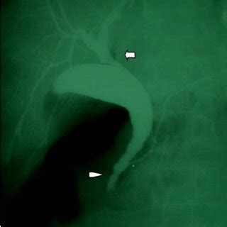 PDF Interposition Of Gallbladder A Rare Extrahepatic Biliary Anomaly
