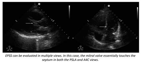 Intern Ultrasound Of The Month Left Ventricular Hypertrophy — University Hospitals Emergency
