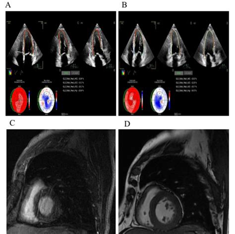 A Case Of Subclinical Immune Checkpoint Inhibitor Associated Myocarditis In Non Small Cell Lung