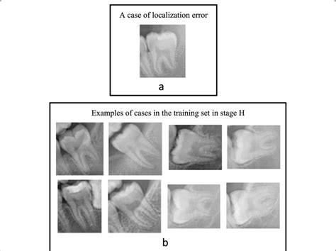 A Case Of Localization Error In Which The Lower Left Third Molar