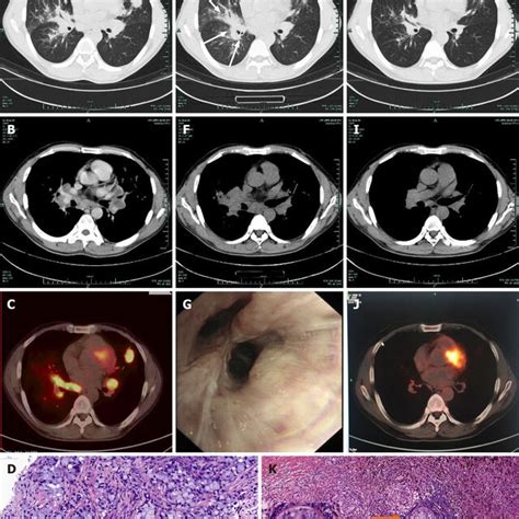 Thoracic Computed Tomography Scan Positron Emission Download