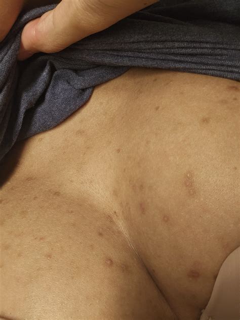 Fade Fa Hyperpigmentation On Chest Rfungalacne