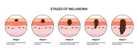 Melanoma Stages Poster Stock Vector Illustration Of Body 274704506