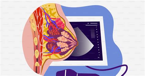Mamología Ultrasonido diagnóstico ecografista,Examinar glándula láctea ...