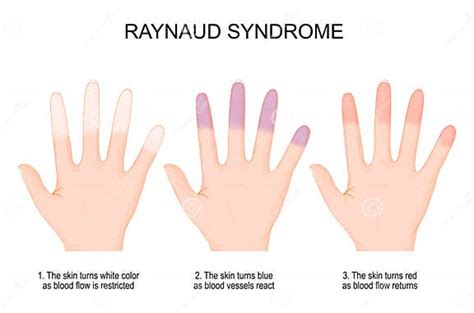 Hands Of A Person With Raynaud`s Phenomenon From White Color When Blood