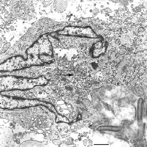Lung Cat No 1 Diffuse Severe Bronchointerstitial Pattern