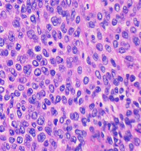 Histopathology Slide Of Diffuse Large B Cell Lymphoma Showing Diffuse Download Scientific