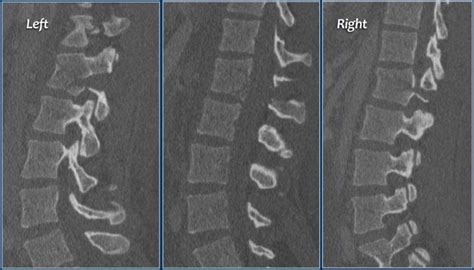 The Radiology Assistant Tlics Classification Of Fractures