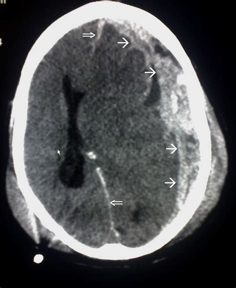 Subdural Hemorrhage Concise Medical Knowledge