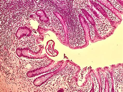 Image Of The Week Enterobius Vermicularis In Appendix