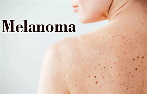 Nodular Melanoma Causes Symptoms Diagnosis And Treatment
