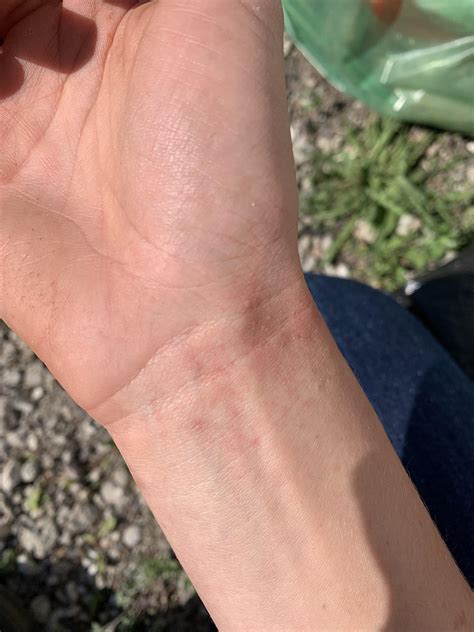 Scabies Or Eczema Rscabies