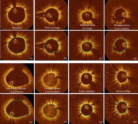 Examples Of Automated Stent Strut Detection In Cases With Different