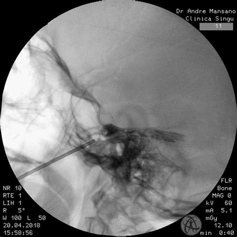 Complications Of Percutaneous Trigeminal Ganglion Procedures Anesthesia Key