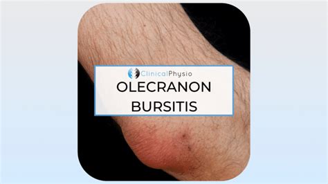 Olecranon Bursitis Clinical Physio Membership