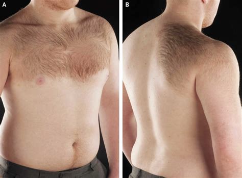 Beckers Nevus Causes Symptoms Diagnosis And Treatment