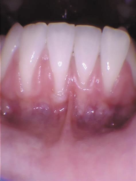 Labial Frenectomy Before And After