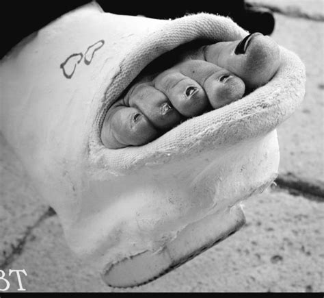 Slwc Plaster Leg Cast In 2023 It Cast Leg Cast