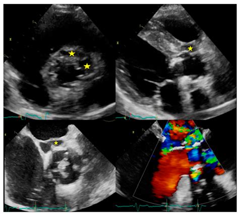 Complications Of Ie Top Example Of Peri Aortic Abscess Stars With Download Scientific