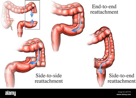 Bladder Problems After Colon Resection At Makayla Moffatt Blog