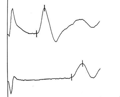 Topic 74 And 75 Investigations In Case Of Polyneuropathy Specific Types Of Polyneuropathies