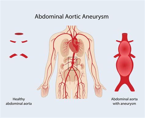 Abdominal Aortic Aneurysm Treatment Perth Dr Altaf